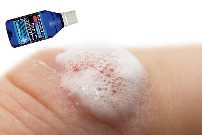 Por que não deve colocar peróxido de hidrogênio (Água Oxigenada) nas ...